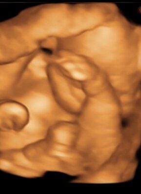 3d 4d es - Affordable Ultrasounds at Jones